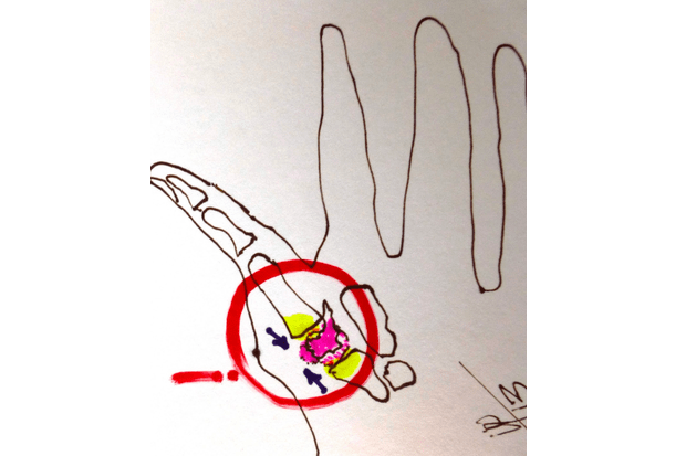 Rhizarthrose ou arthrose trapézo-métacarpienne – Dr Vladimir Mitz